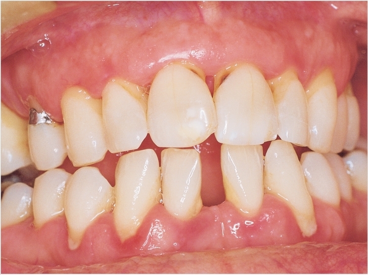 Studies Uncover More Links Between Periodontitis and Cancer | Landis ...